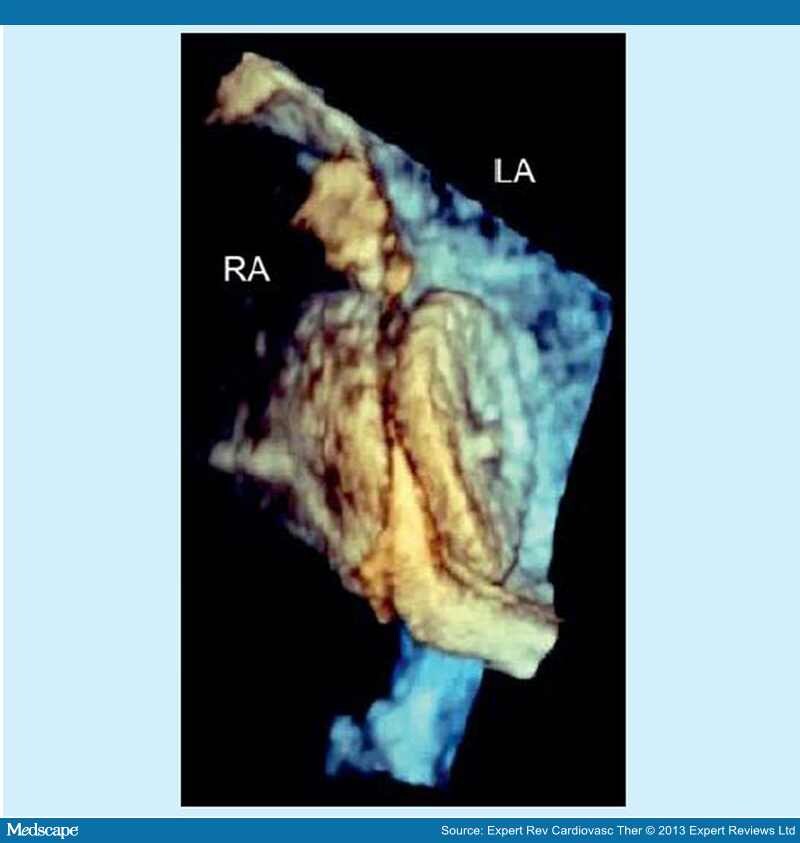 Role of Imaging in Interventions on Structural Heart Disease - Page 2