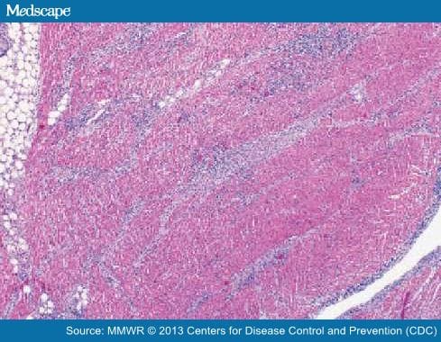 Three Sudden Cardiac Deaths Associated With Lyme Carditis