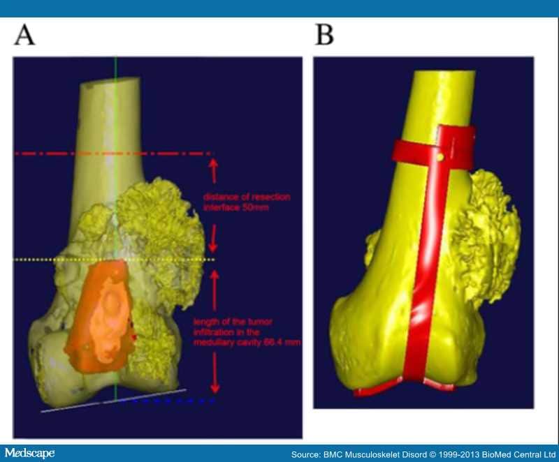 Computer-Aided Resection for Bone Tumors Around the Knee - Page 4