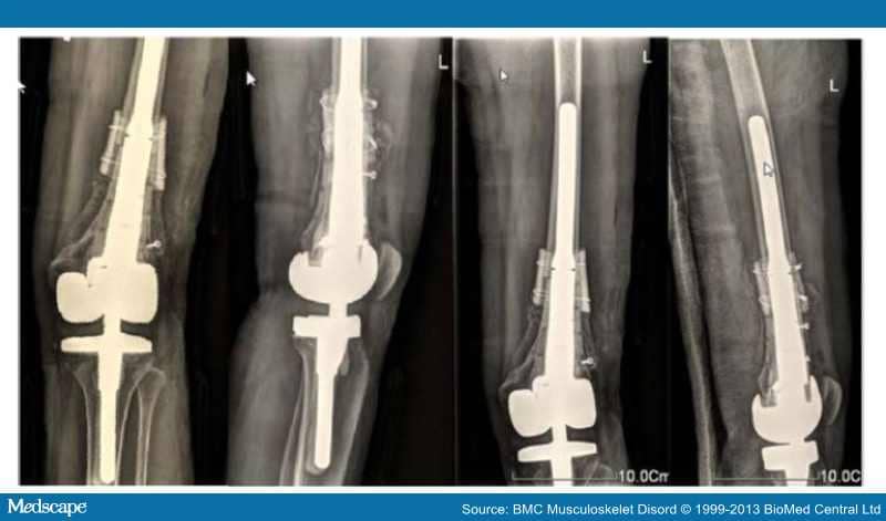 Computer-Aided Resection for Bone Tumors Around the Knee - Page 4