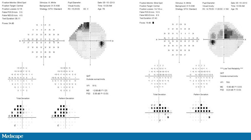 A 78-Year-Old Man With Sudden Central Vision Loss