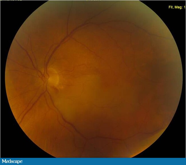 A 78-Year-Old Man With Sudden Central Vision Loss - Page 2
