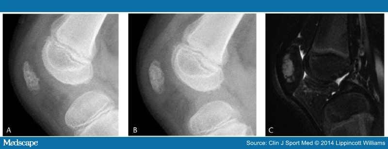 Osteochondrosis of the Primary Patellar Ossification Centers - Page 2