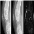 Osteochondrosis of the Primary Patellar Ossification Centers