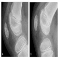 Osteochondrosis of the Primary Patellar Ossification Centers - Page 2