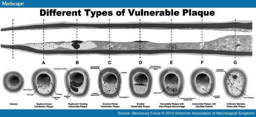 Imaging of High-Risk Carotid Artery Plaques