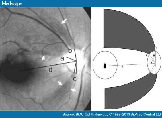 Retinal Nerve Fiber Layer Defects in Patients With Glaucoma - Page 3