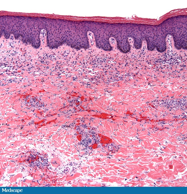 Purple Plaques in a Renal Transplant Recipient (Transcript)