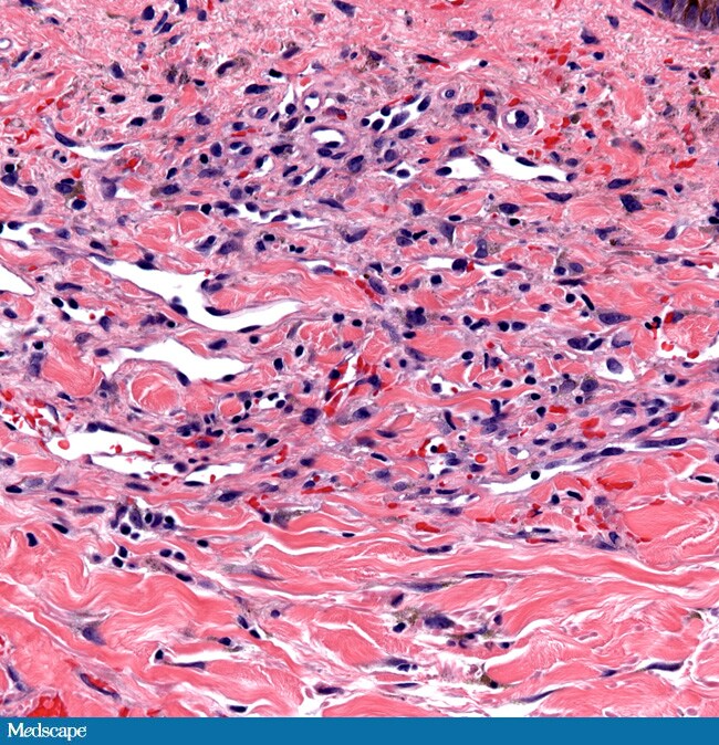 Purple Plaques in a Renal Transplant Recipient (Transcript)