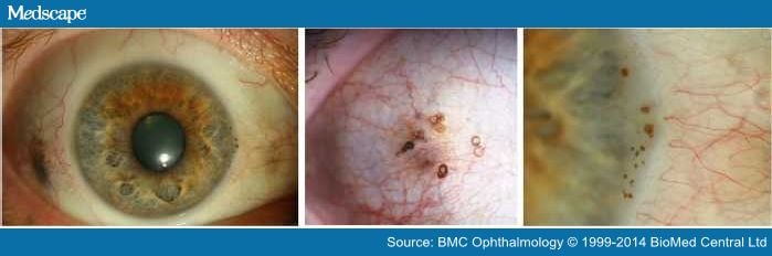 On the Ocular Findings in Ochronosis - Page 4