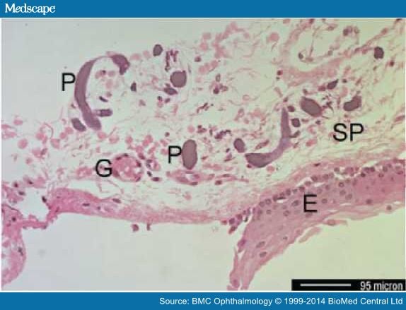 On the Ocular Findings in Ochronosis - Page 4