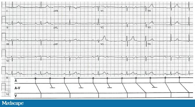 Which Type of AV Block? - Page 2