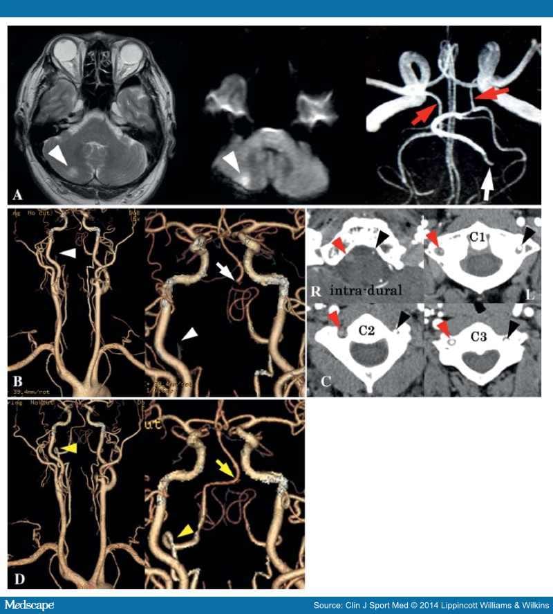 Vertebral Artery Dissection Caused by Swinging a Golf Club - Page 2
