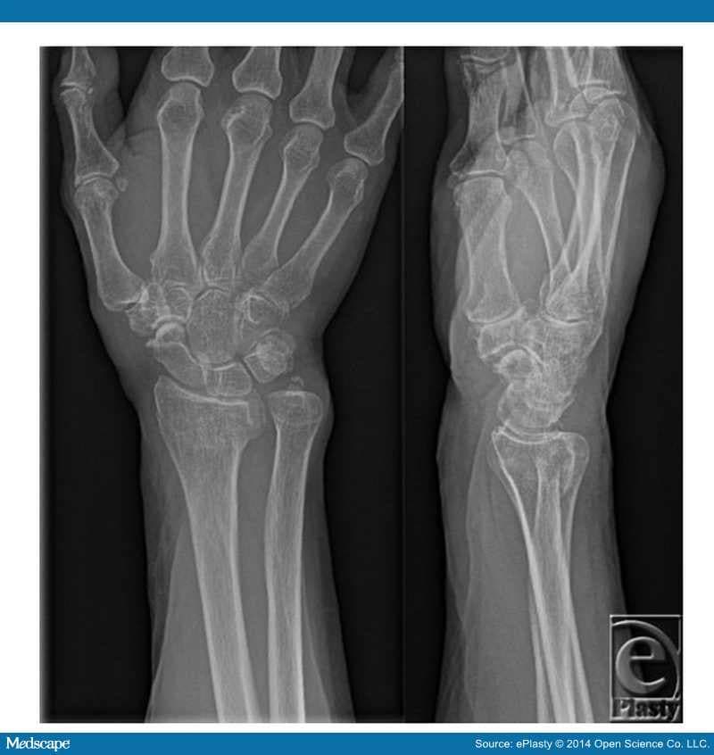 Compartment Syndrome of the Hand