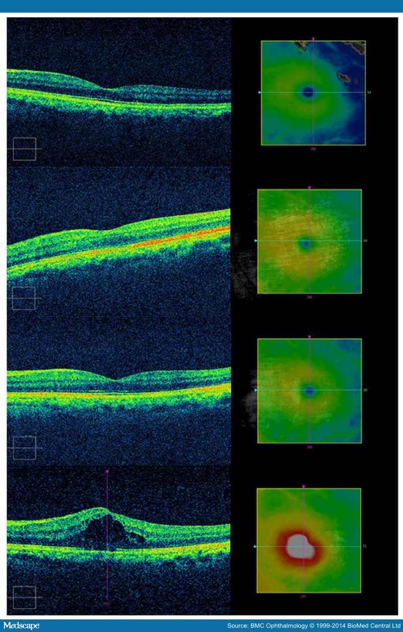 SD-OCT of Cystoid Macular Edema After Phacoemulsification - Page 4