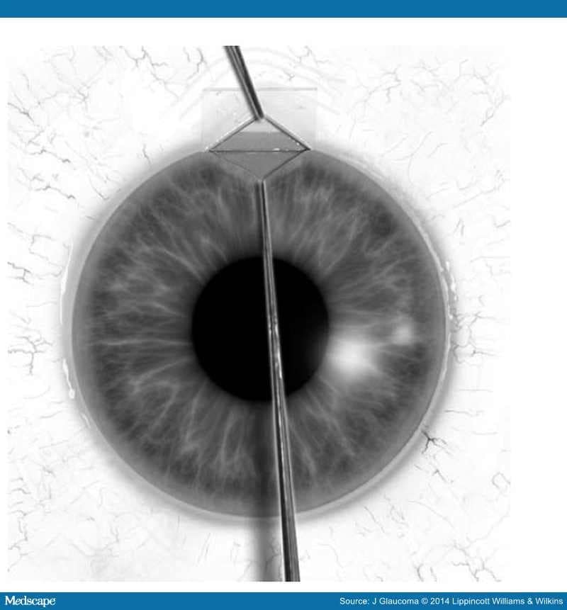 Minimally Invasive Mini-Glaucoma Shunt Implantation - Page 2