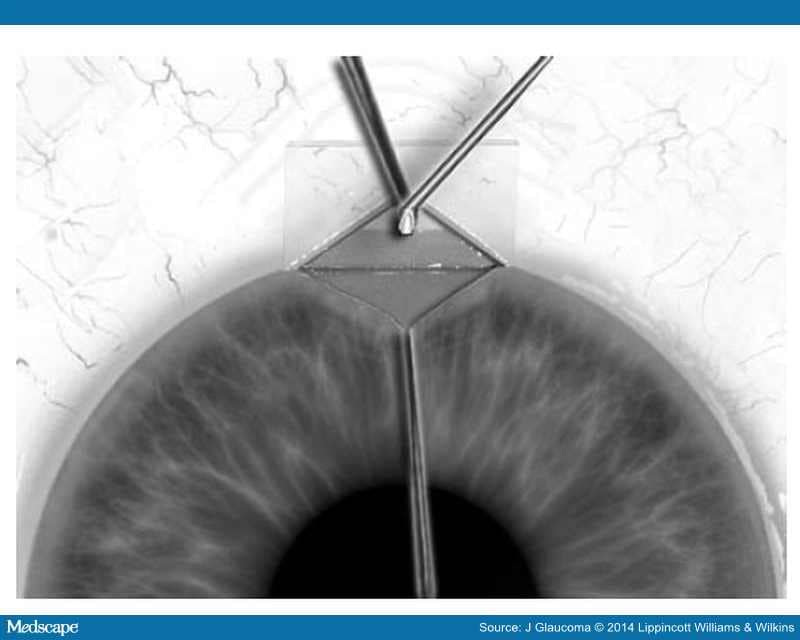 Minimally Invasive Mini-Glaucoma Shunt Implantation - Page 2