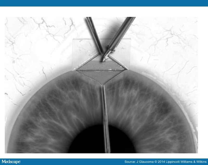 Express Shunt Glaucoma Information