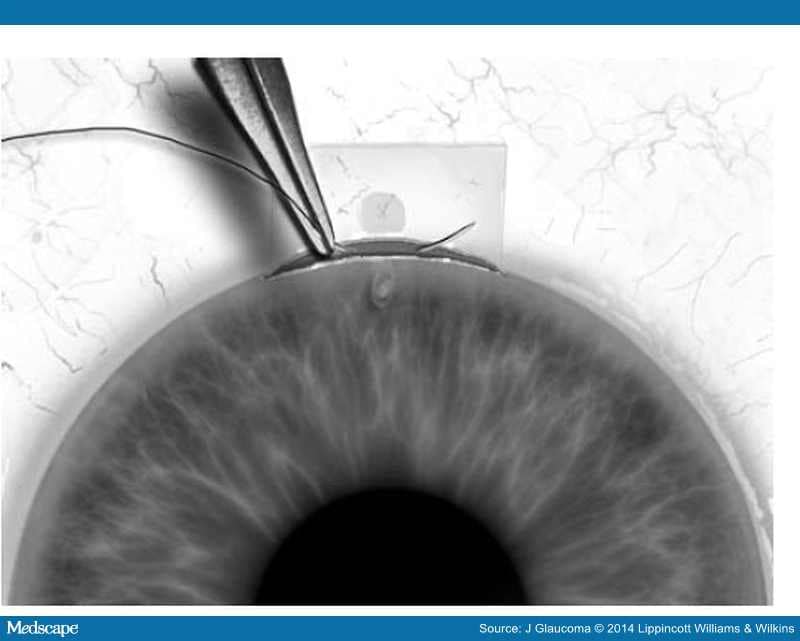 Minimally Invasive Mini-Glaucoma Shunt Implantation - Page 2