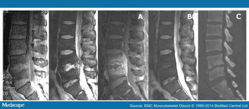 Endoscopic Treatment for Lumbar Infectious Spondylitis - Page 4