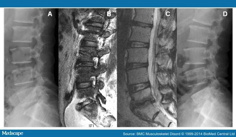 Endoscopic Treatment for Lumbar Infectious Spondylitis - Page 4