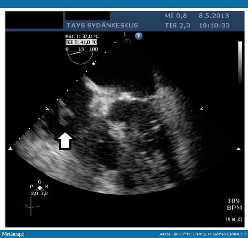 Cardiac Device-Related Endocarditis Due to Streptococcus - Page 3