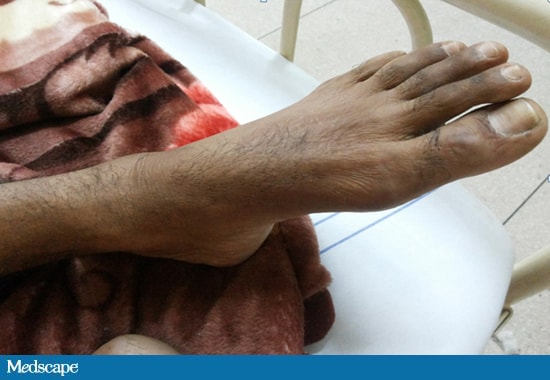 Pain and Numbness in the Arms and Legs With Foot Drop - Page 3