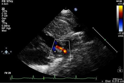 Treating Patent Ductus Arteriosus in Neonates: Evaluating Current Therapies