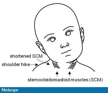 Nonsynostotic Deformational Plagiocephaly - Page 4