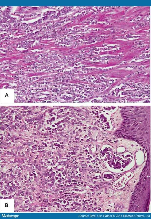 Pleomorphic Lobular Carcinoma of the Male Breast - Page 3