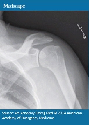 'Light Bulb Sign' in Posterior Shoulder Dislocation