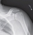 'Light Bulb Sign' in Posterior Shoulder Dislocation