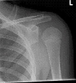 'Light Bulb Sign' in Posterior Shoulder Dislocation