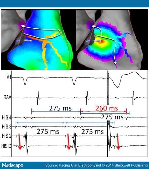 Principles of Differential Diagnostic Pacing Maneuvers - Page 3