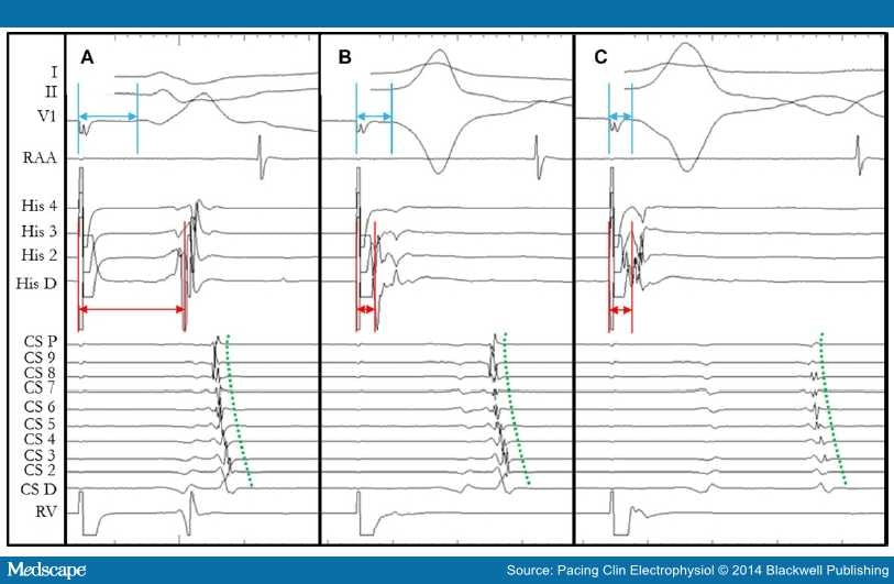 Principles of Differential Diagnostic Pacing Maneuvers - Page 10
