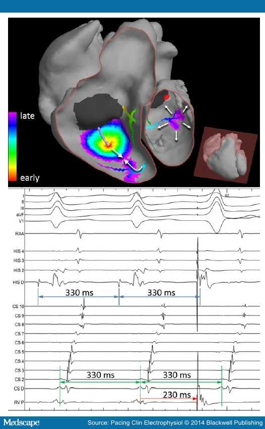 Principles of Differential Diagnostic Pacing Maneuvers - Page 3