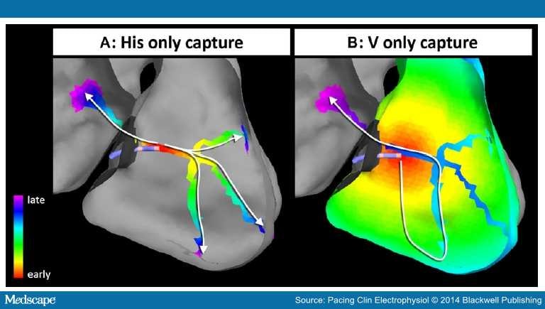 Principles of Differential Diagnostic Pacing Maneuvers - Page 7