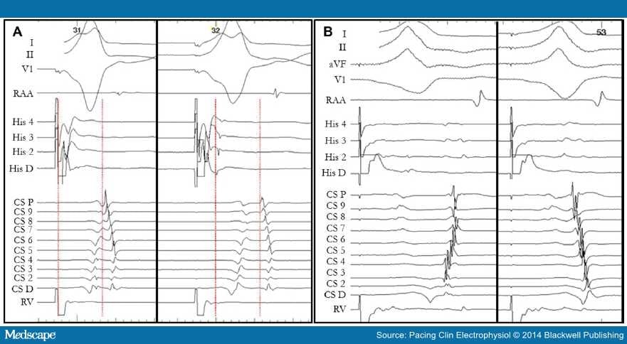 Principles of Differential Diagnostic Pacing Maneuvers - Page 7