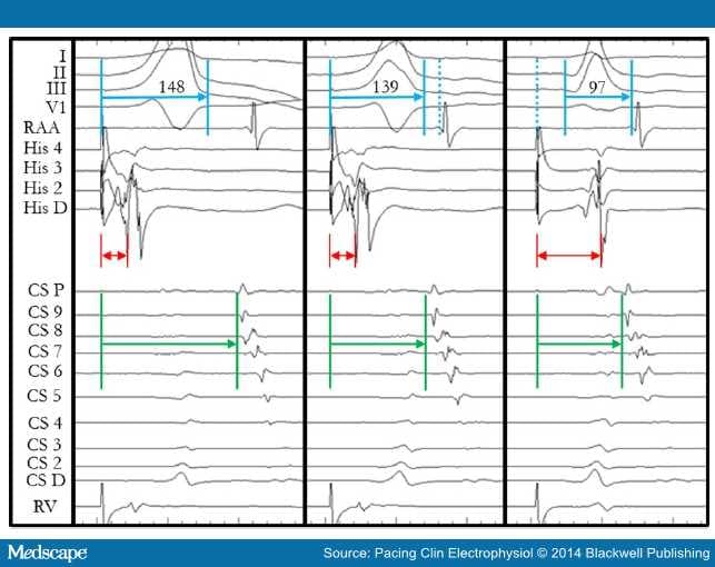 Principles of Differential Diagnostic Pacing Maneuvers - Page 7