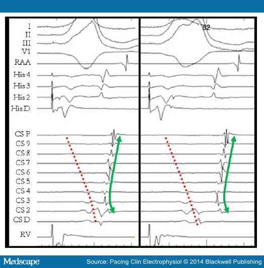 Principles of Differential Diagnostic Pacing Maneuvers - Page 7