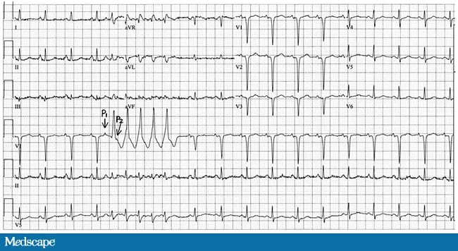 Tachycardia With a Six-Million-Dollar Clue - Page 2