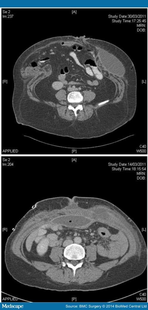 Component Separation and Mesh Reinforcement in Hernia Repair - Page 4