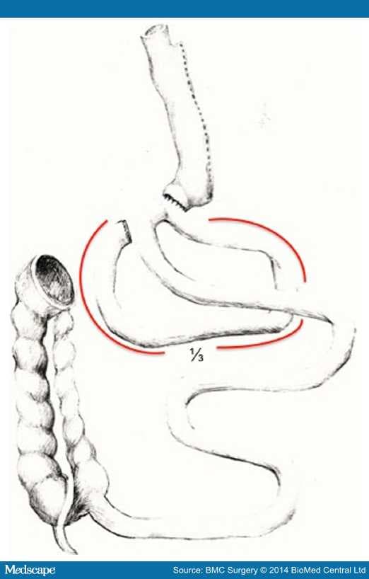 Loop Duodeno-Enterostomy With Sleeve Gastrectomy - Page 3