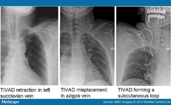 Totally Implantable Venous Access Devices - Page 4