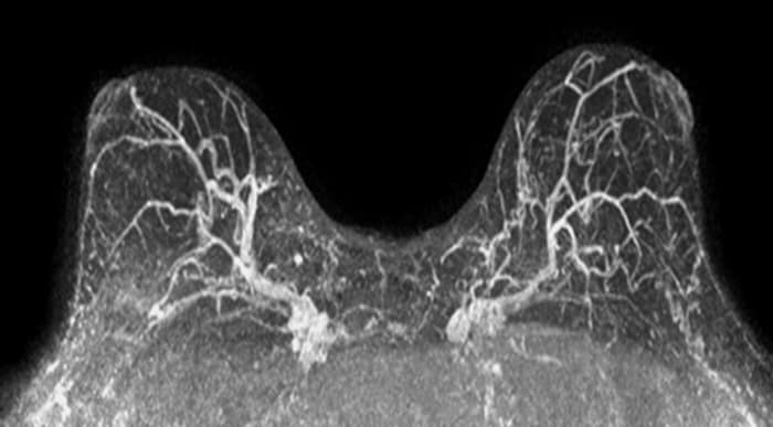 Application of MRI for Treatment Decisions in Breast Cancer