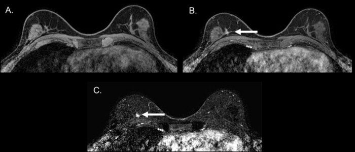 Application of MRI for Treatment Decisions in Breast Cancer