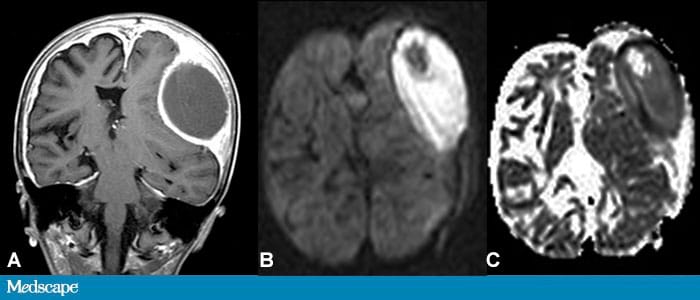 MRI of CNS Infection and Inflammation in Pediatric Patients