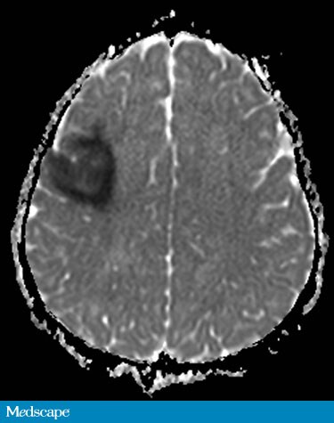 MRI of CNS Infection and Inflammation in Pediatric Patients