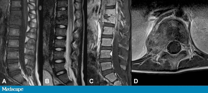 MRI of CNS Infection and Inflammation in Pediatric Patients