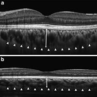 Influence of Choroidal Thickness on Subfoveal Choroidal Thickness ...